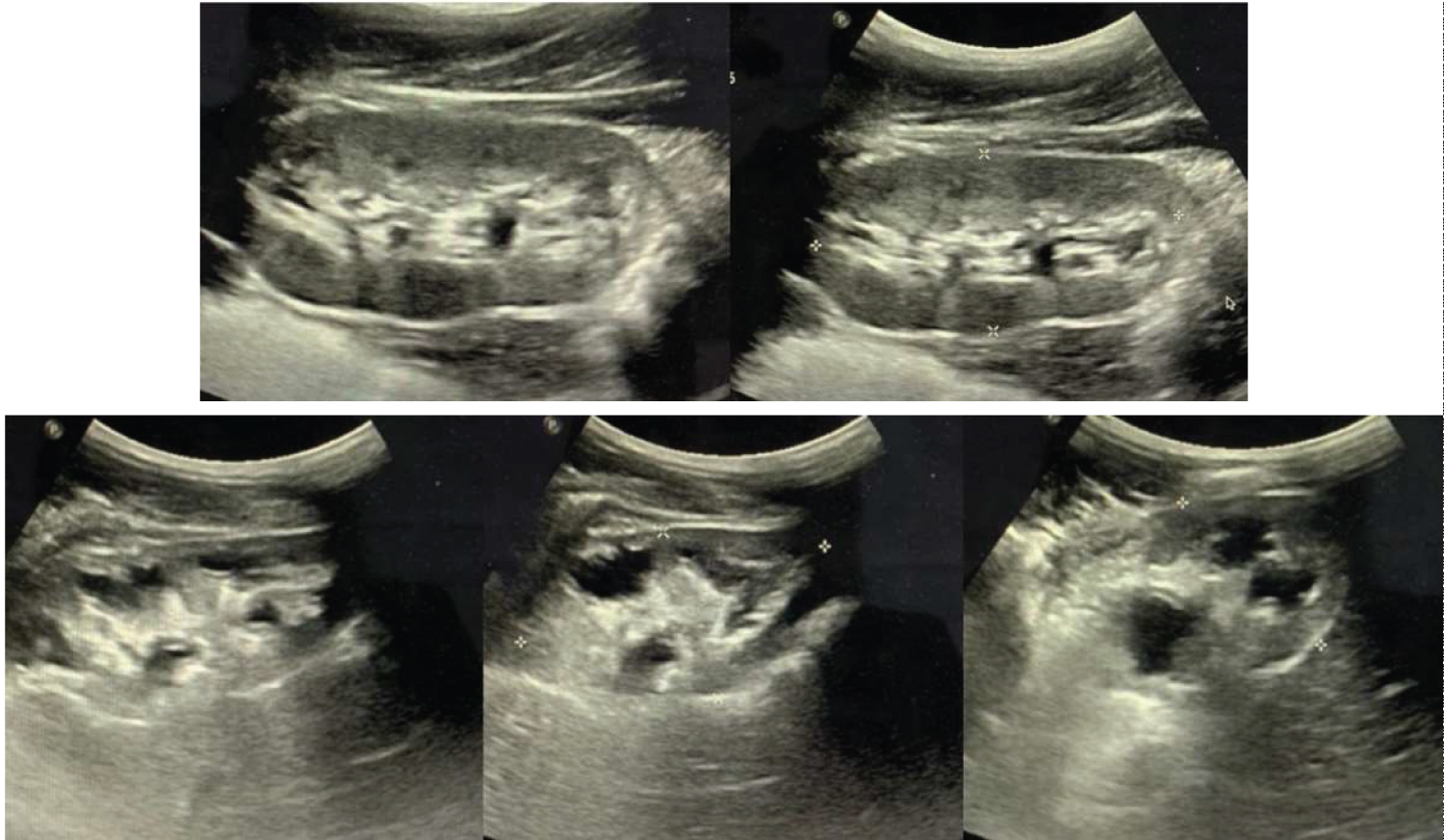 Bilateral Hydronephrosis As A Consequence Of Vesicoureteral Reflux In A Bilateral Hydronephrosis As A Consequence Of Vesicoureteral Reflux In A