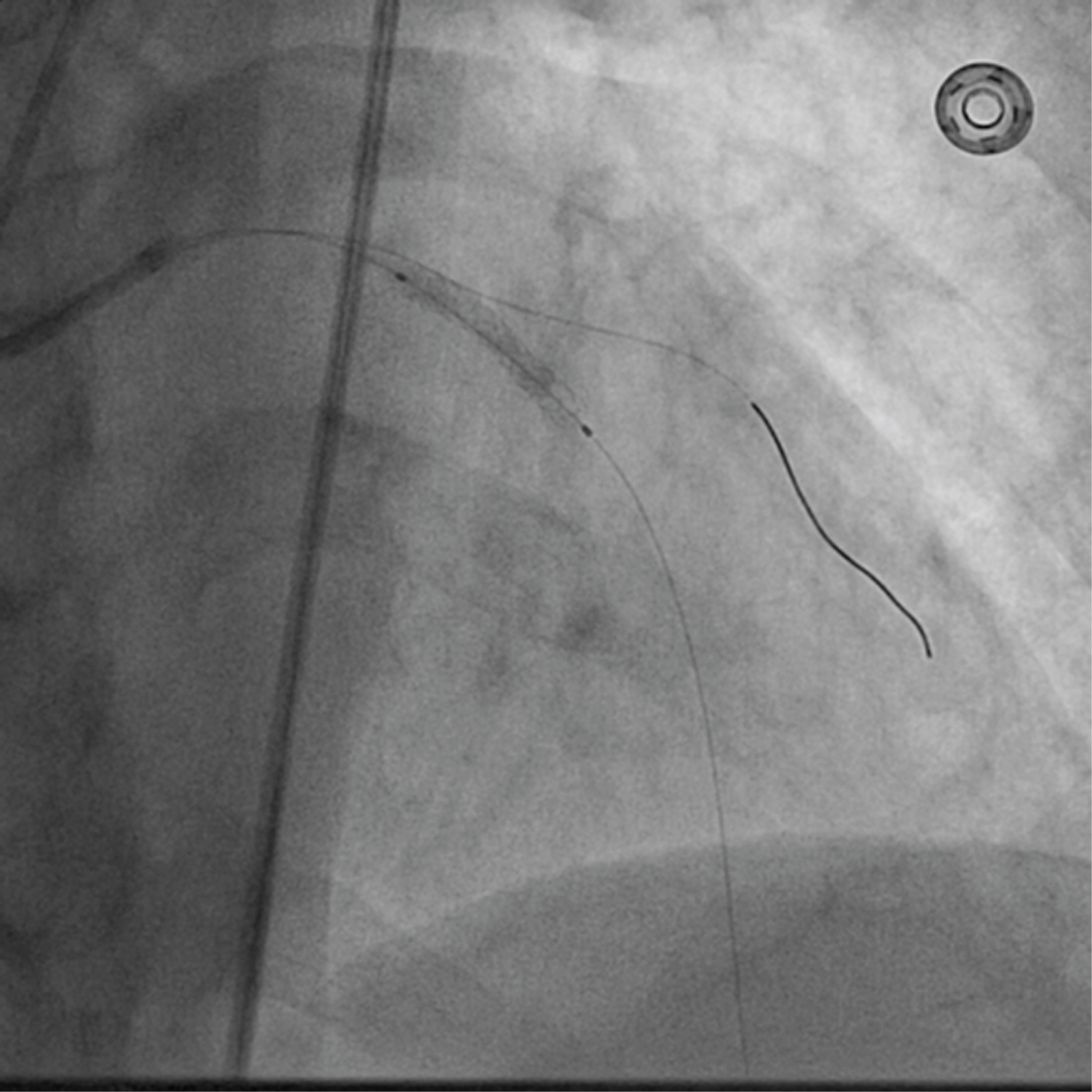 Icd 10 Code For History Of Mi With Stent Placement