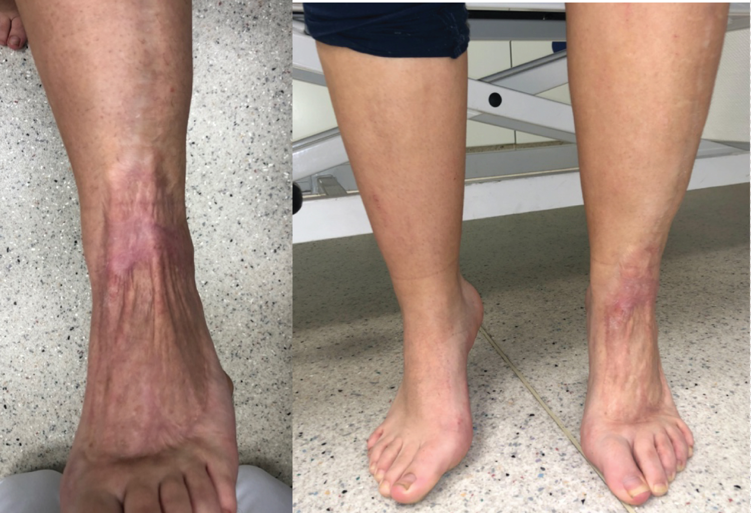 Necrotizing Fasciitis And Meningitis Due To Streptococcus 55 OFF Necrotizing Fasciitis And Meningitis Due To Streptococcus 55 OFF