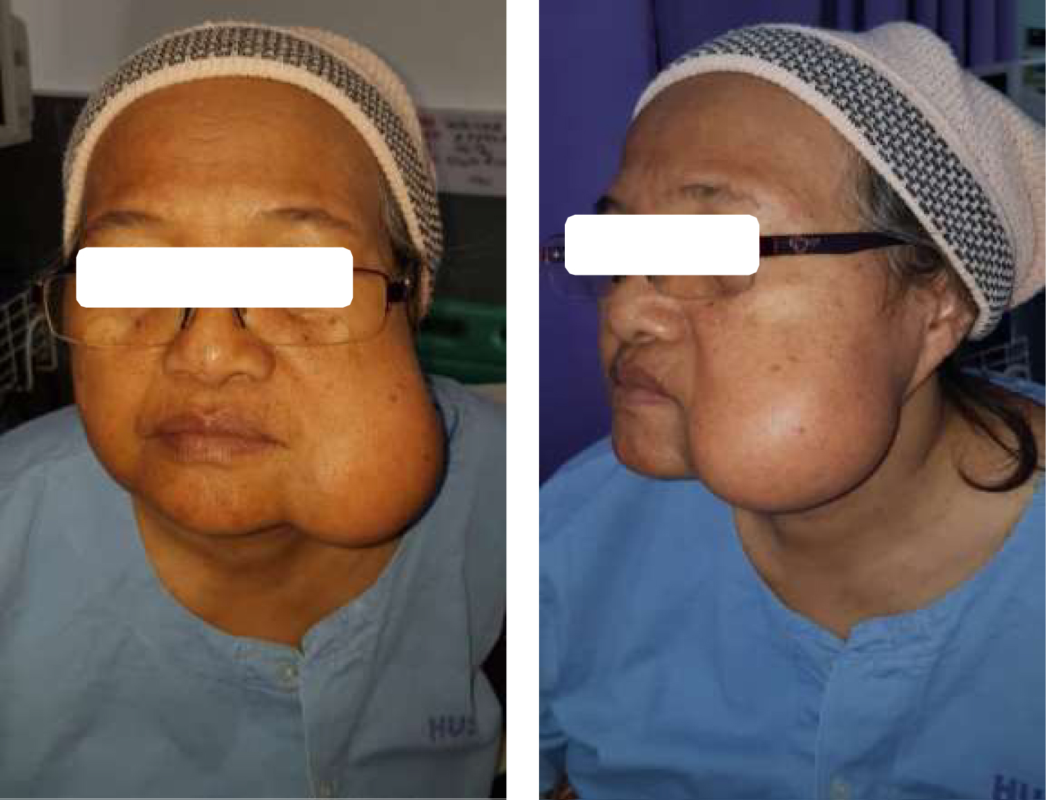 Intra Oral Approach Of Giant Cheek Lipoma Excision Guaranteed Aesthetic Intra Oral Approach Of Giant Cheek Lipoma Excision Guaranteed Aesthetic