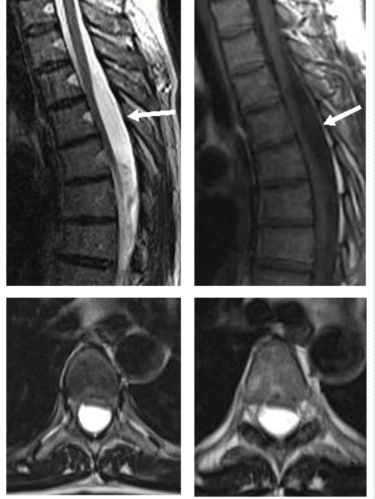 Spinal Arachnoid Cyst